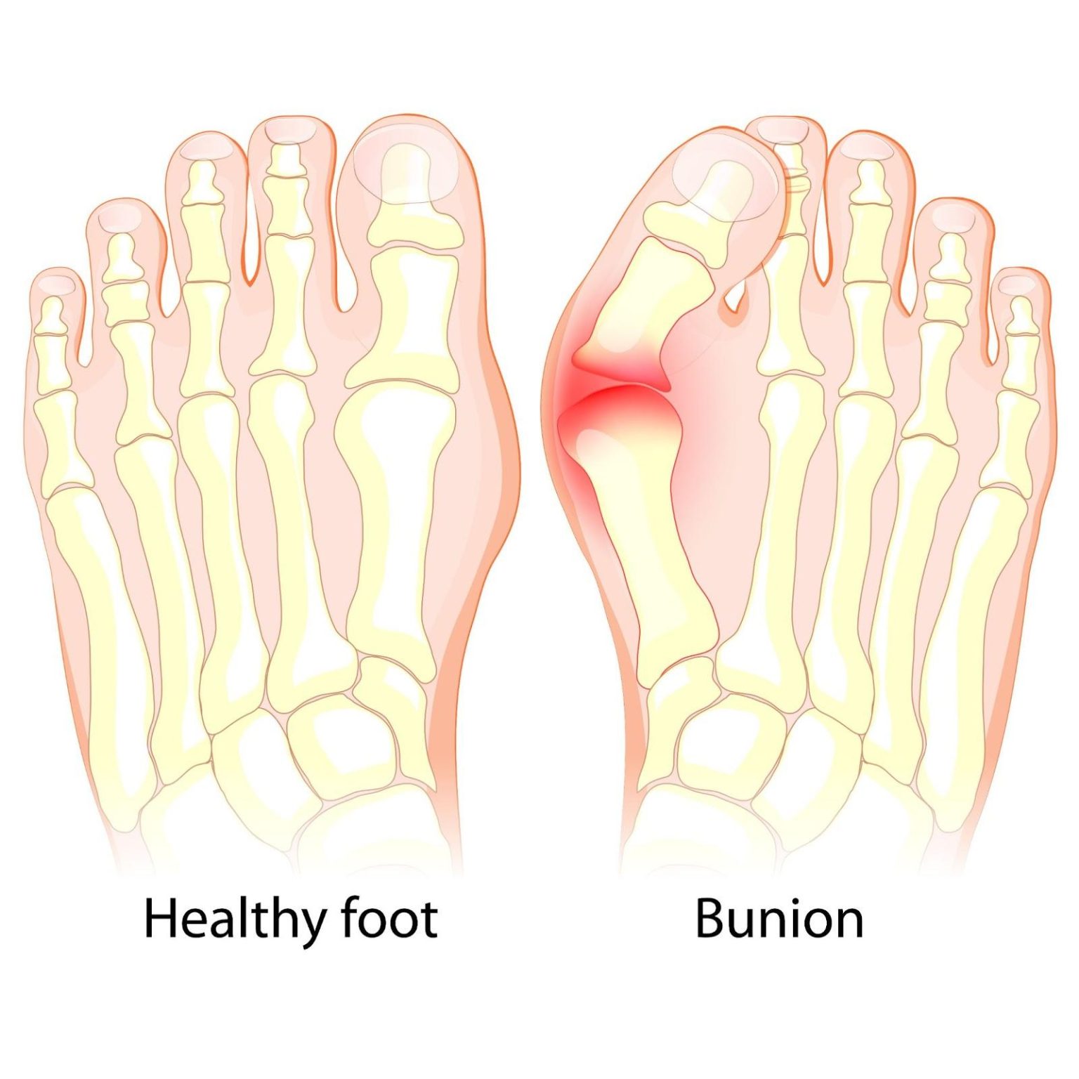 Intermetatarsal Bursitis - Cove Orthopaedic Clinic | Minimally Invasive ...