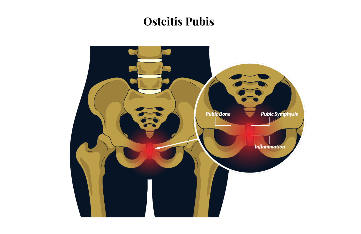 Osteitis Pubis Treatment in Singapore - Cove Orthopaedic Clinic | Cove ...